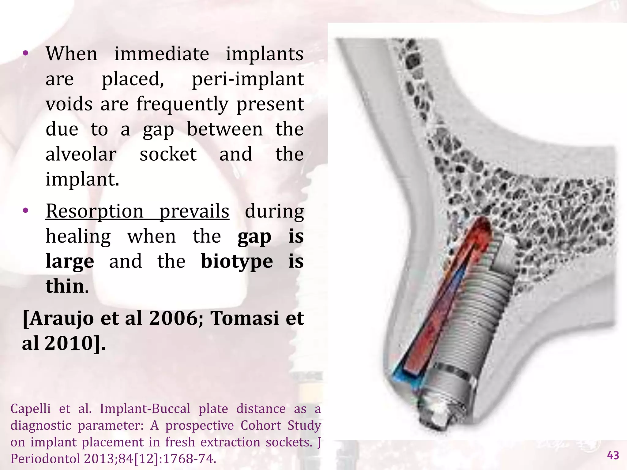Immediate implants | PPTX