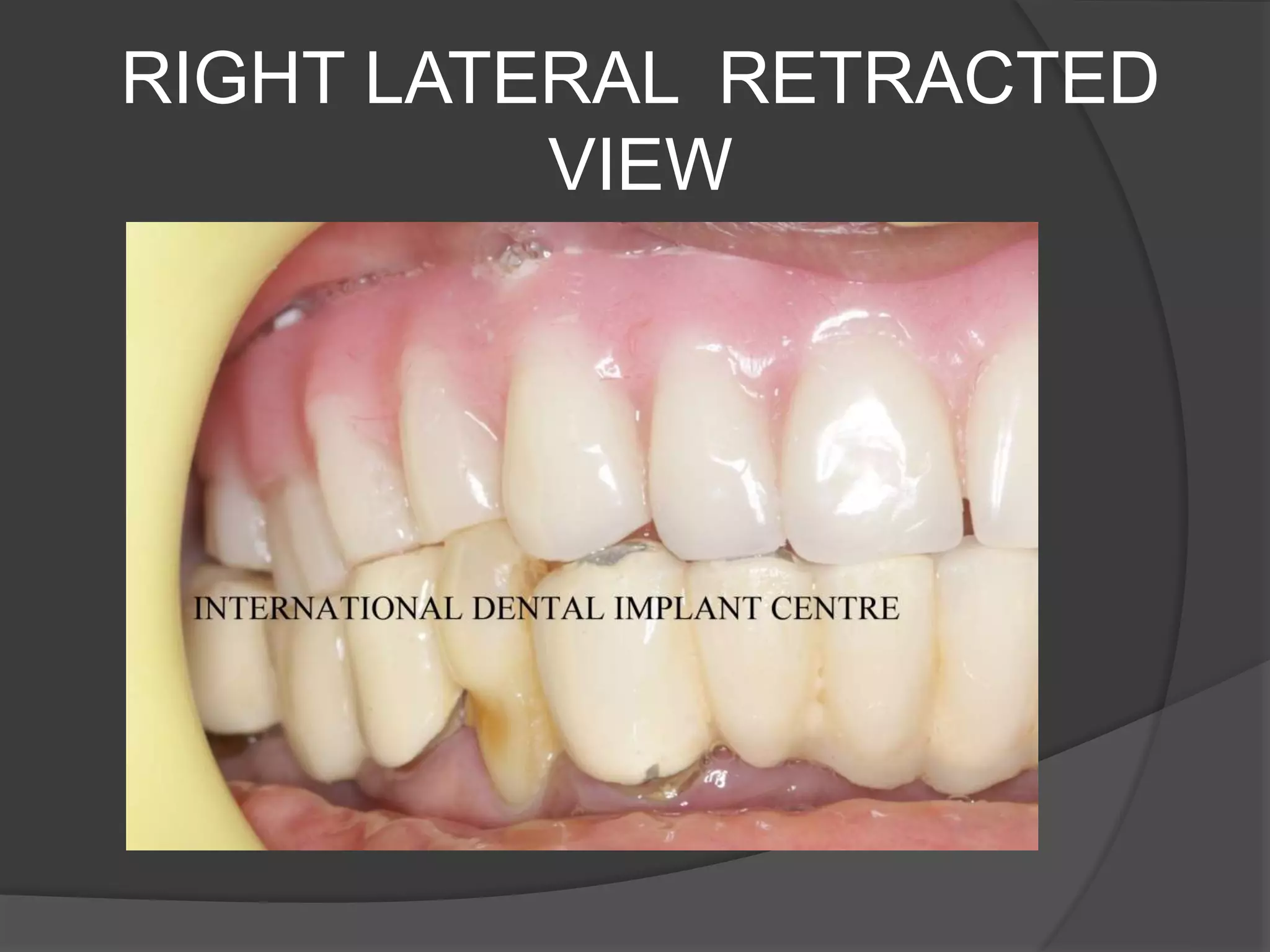 Immediate loading basal dental implants in chennai | PPTX