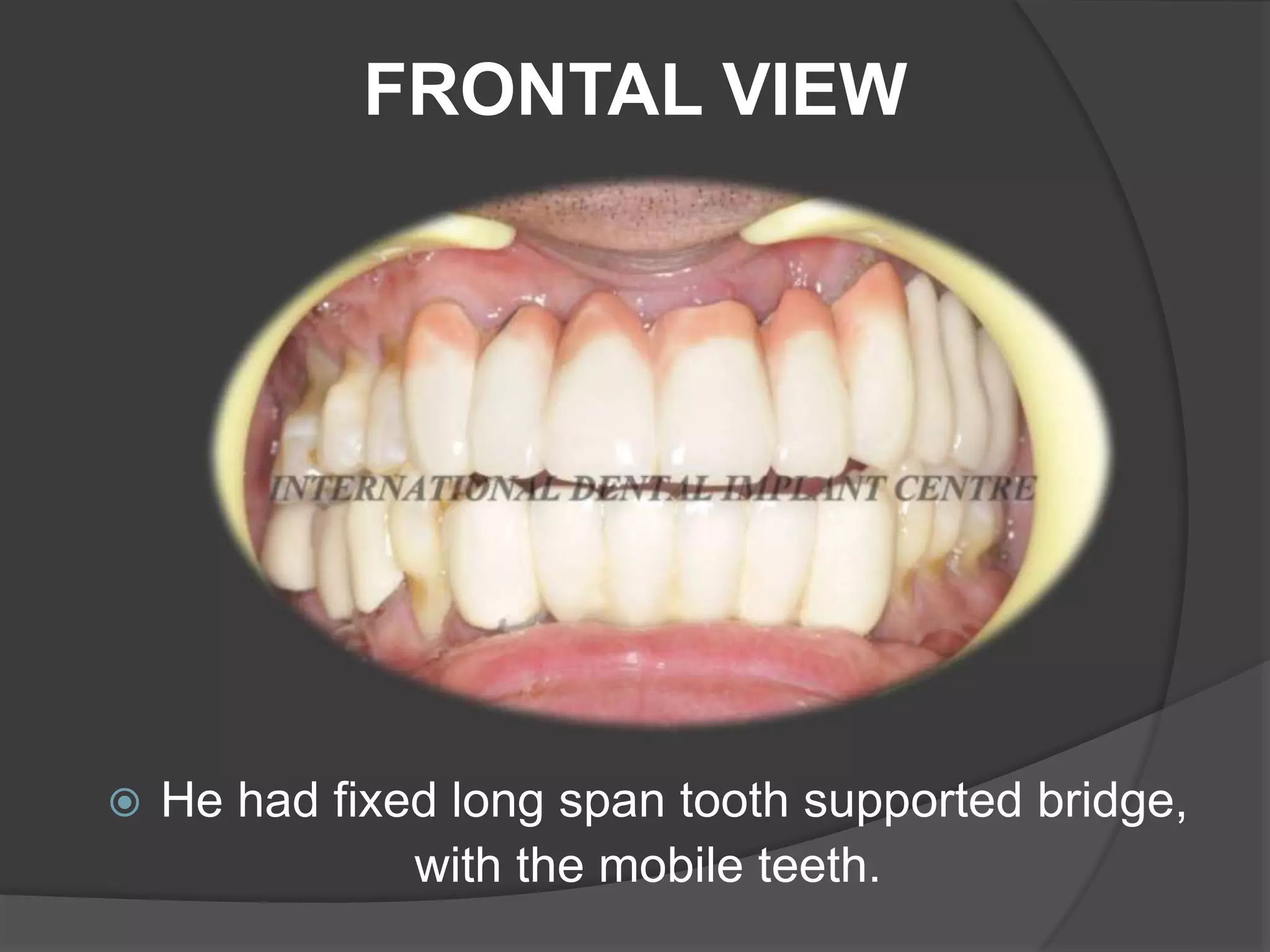 Immediate loading basal dental implants in chennai | PPTX