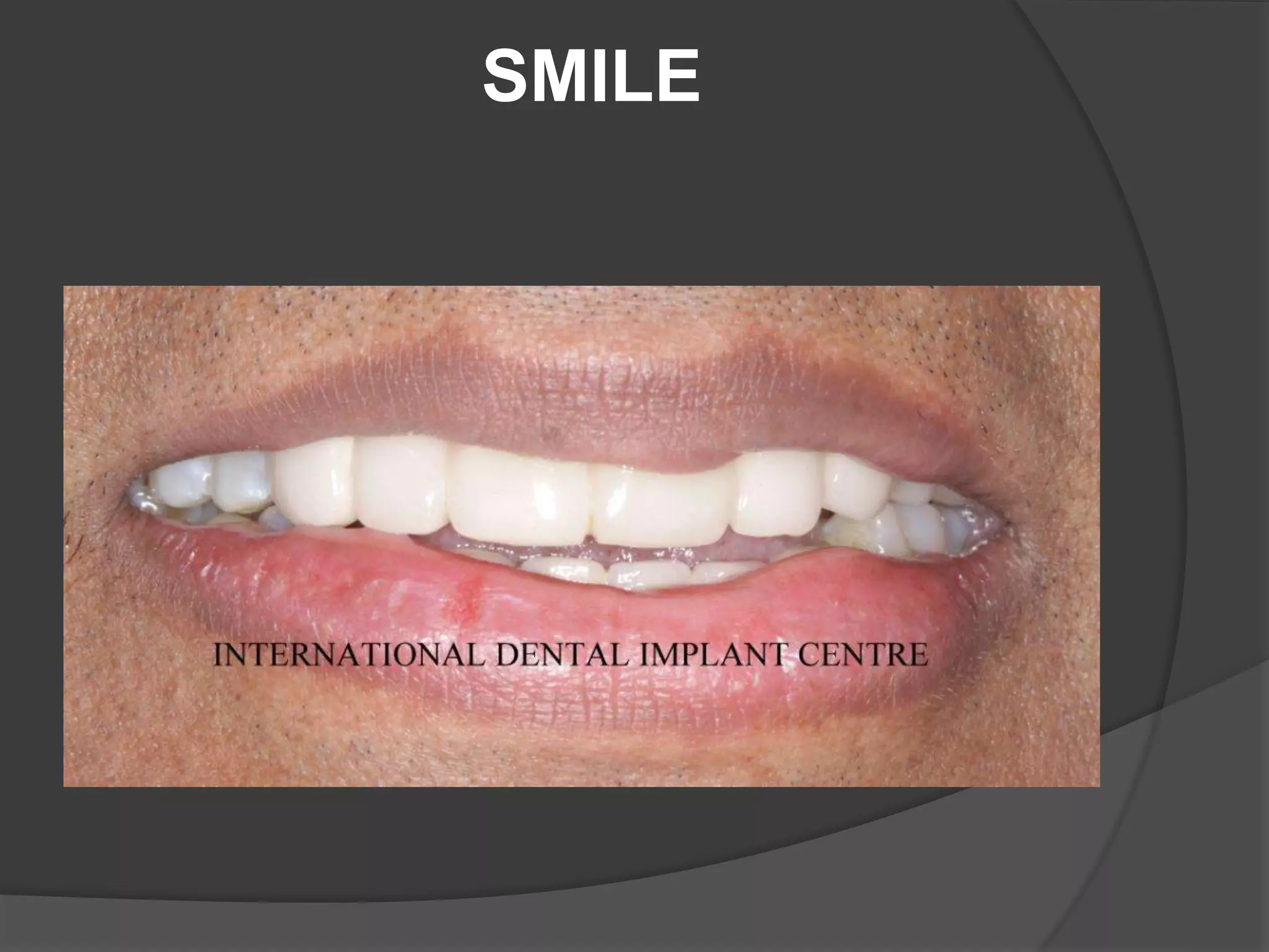 Immediate loading basal dental implants in chennai | PPTX