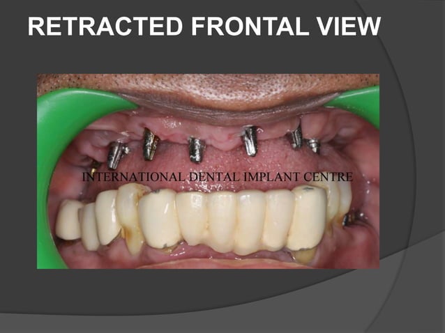 Immediate loading basal dental implants in chennai | PPT