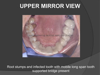 Immediate loading basal dental implants in chennai | PPTX | Dental ...