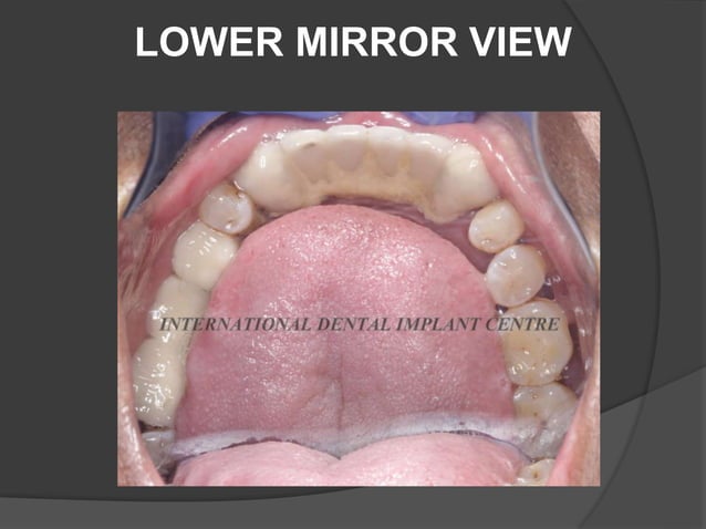 Immediate loading basal dental implants in chennai | PPT