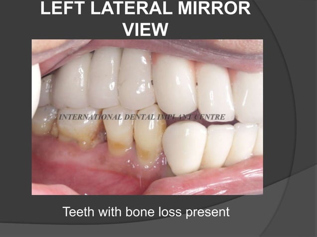 Immediate loading basal dental implants in chennai | PPT