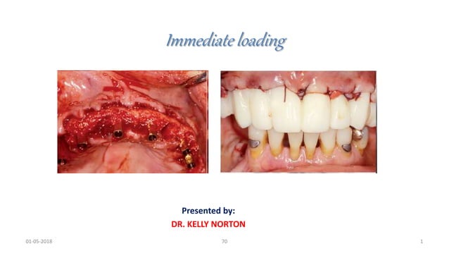 Immediate loading- Kelly | PPTX