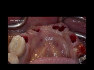 Immediate placement and loading of xive implants in | PPTX