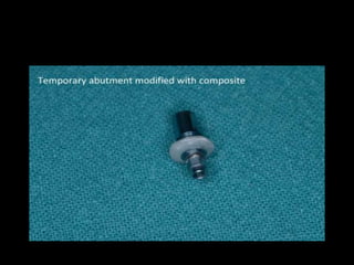 Immediate placement and loading of xive implants in | PPTX