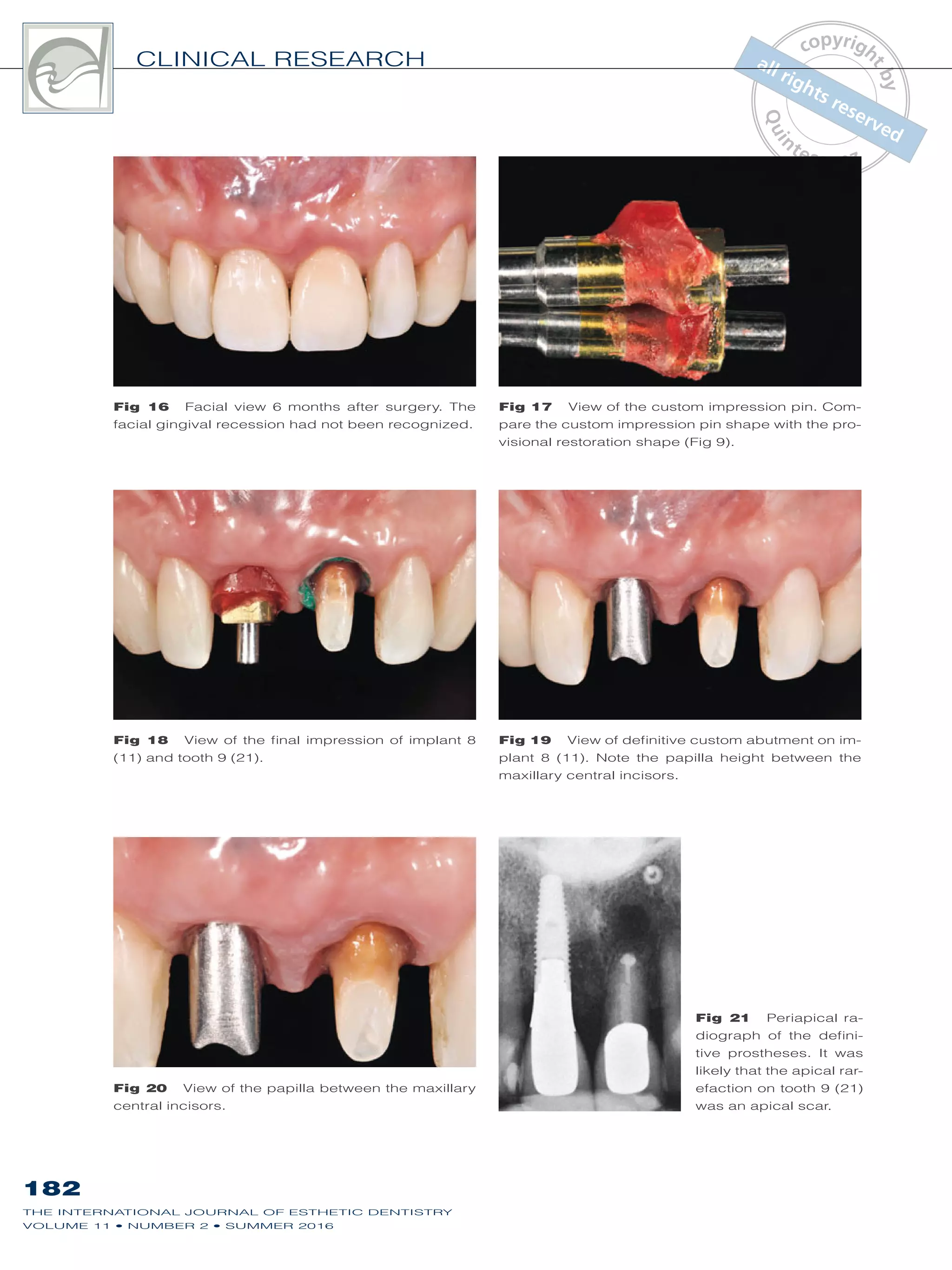 Immediate placement and provisionalization of maxillary anterior single implant with guided bone ...