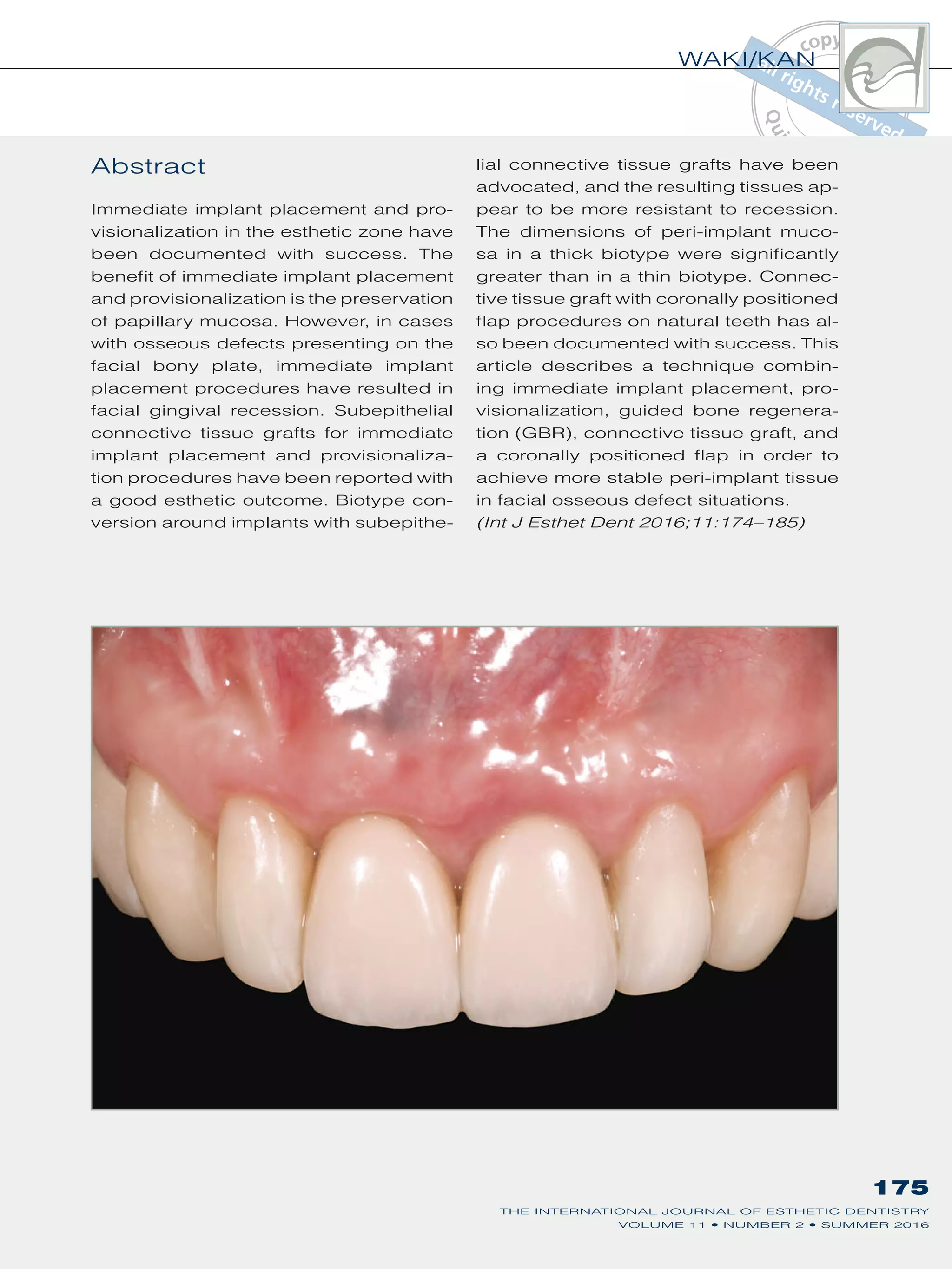 Immediate placement and provisionalization of maxillary anterior single implant with guided bone ...