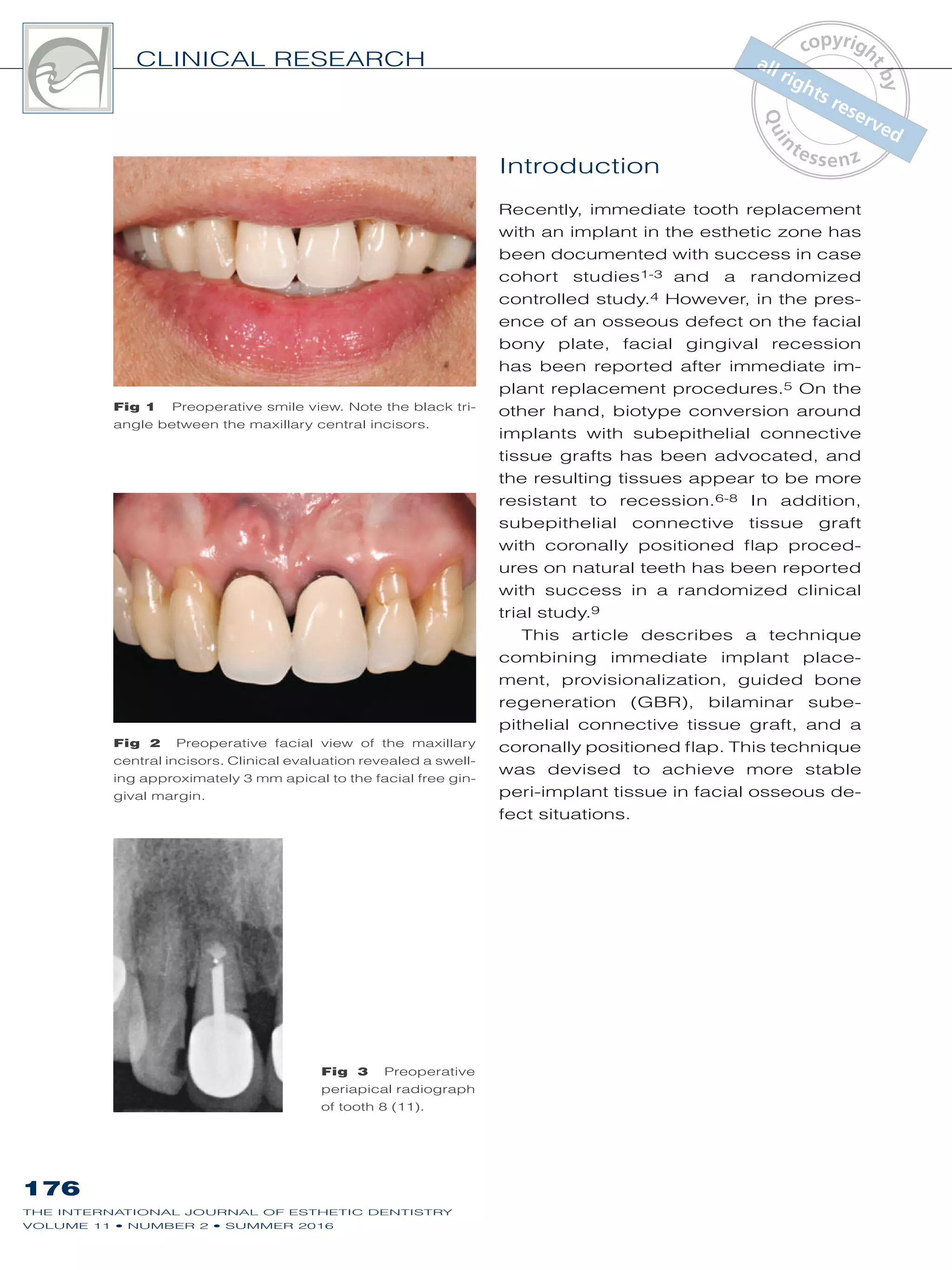 Immediate placement and provisionalization of maxillary anterior single implant with guided bone ...