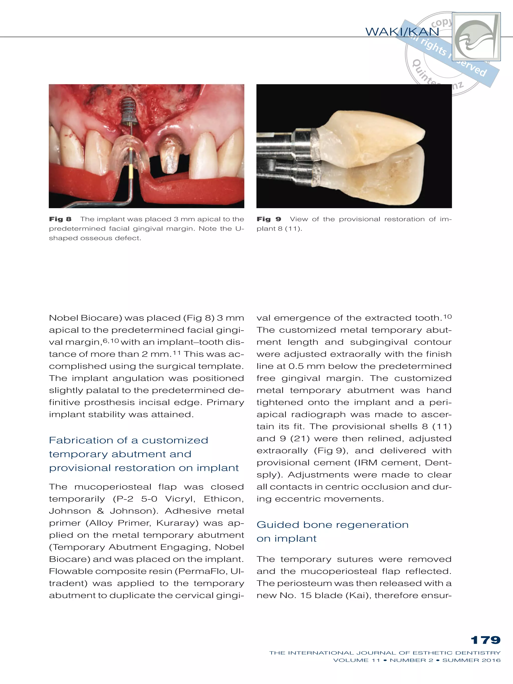 Immediate placement and provisionalization of maxillary anterior single implant with guided bone ...