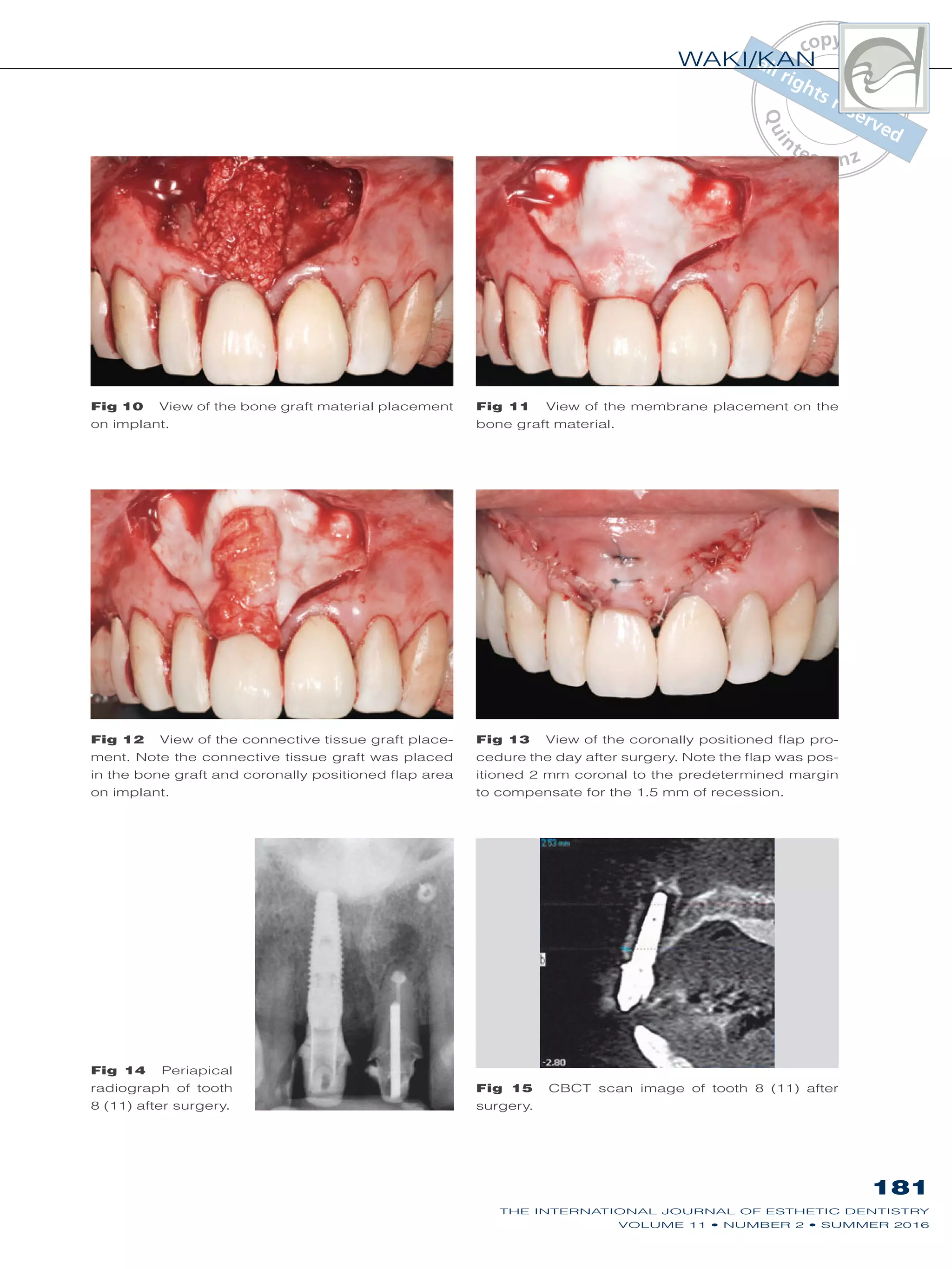 Immediate placement and provisionalization of maxillary anterior single implant with guided bone ...