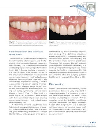 Immediate placement and provisionalization of maxillary anterior single implant with guided bone ...