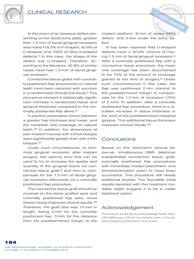 Immediate placement and provisionalization of maxillary anterior single implant with guided bone ...