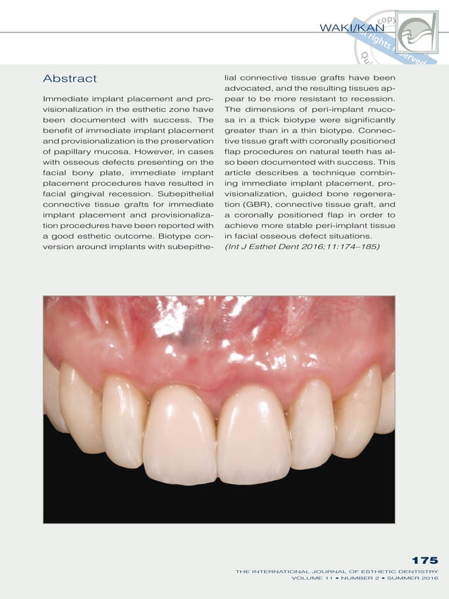 Immediate placement and provisionalization of maxillary anterior single implant with guided bone ...