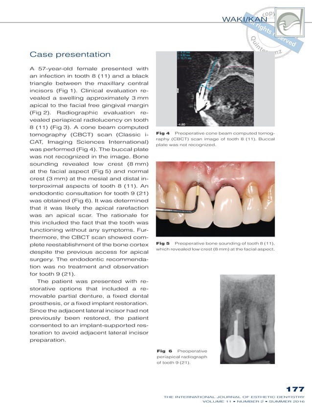 Immediate placement and provisionalization of maxillary anterior single implant with guided bone ...