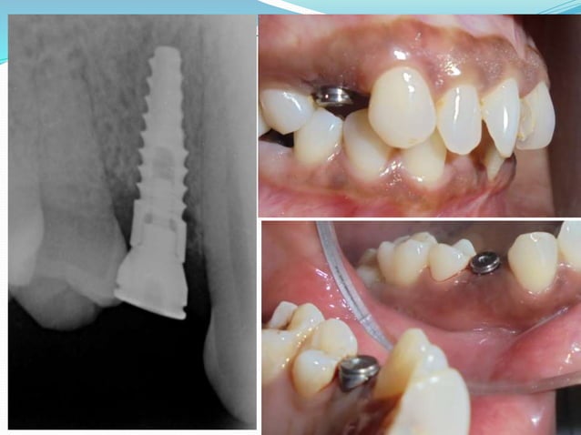 Immediate single implant case presentation | PPTX | Dental Health ...