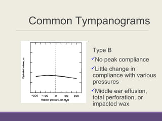 Tympanosclerosis Tympanogram