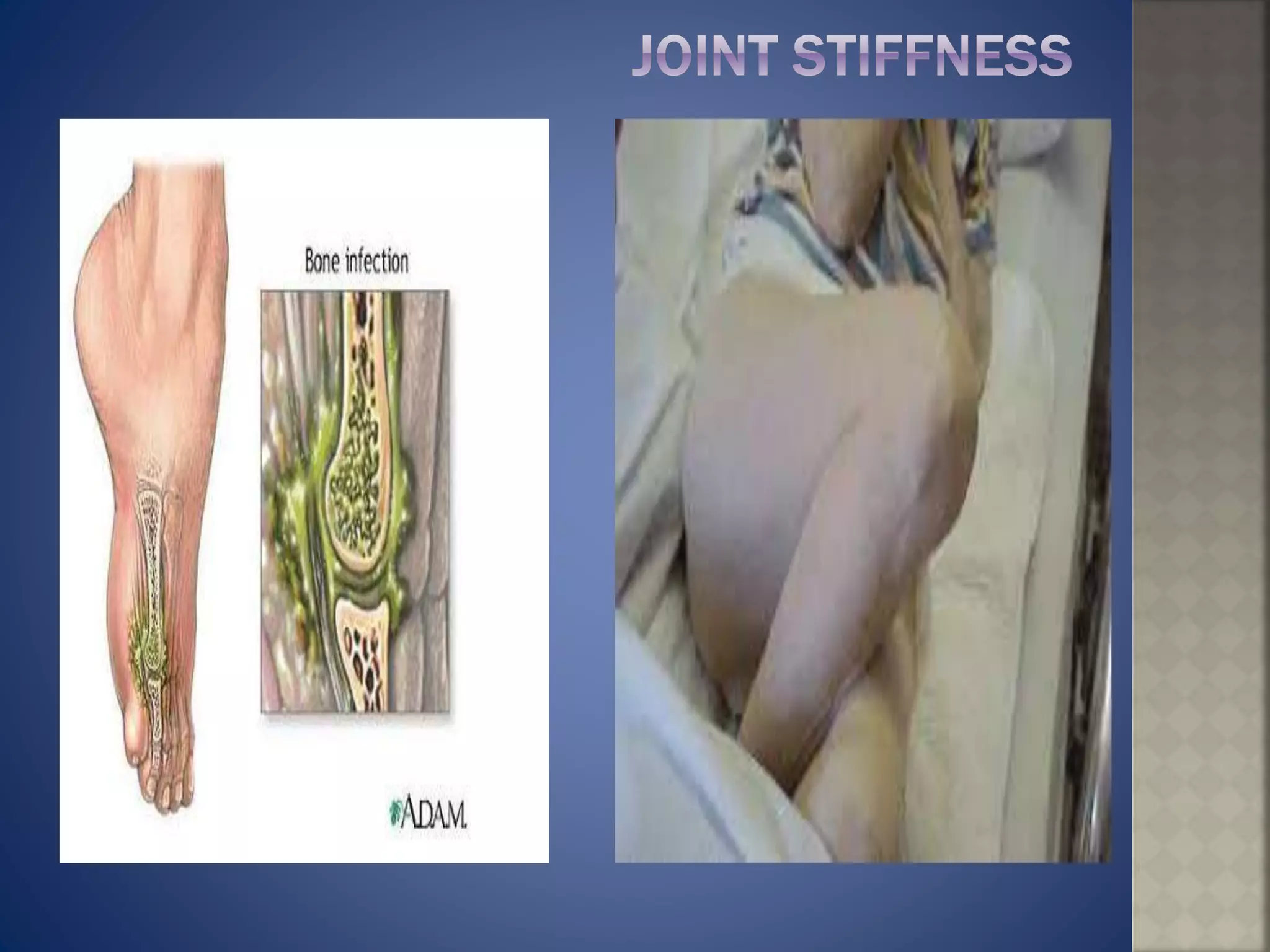 Immobility (Bed Rest Complications) | PPTX