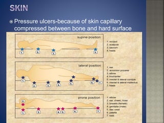 Immobility (Bed Rest Complications) | PPTX