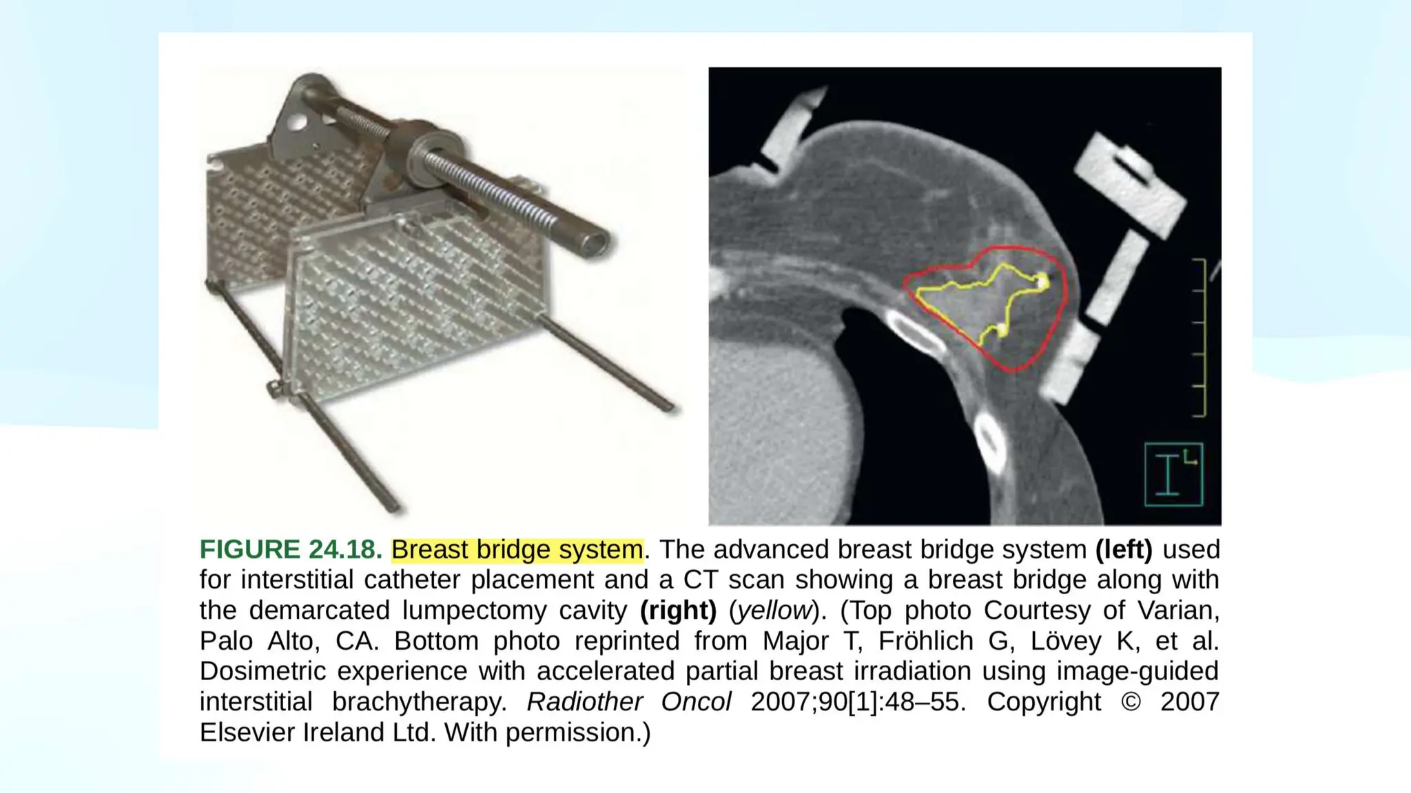 Immobilization Devices.pptx ;DR YAMINI ; RADIOTHERAPY ; AIIMS GORAKHPUR ...