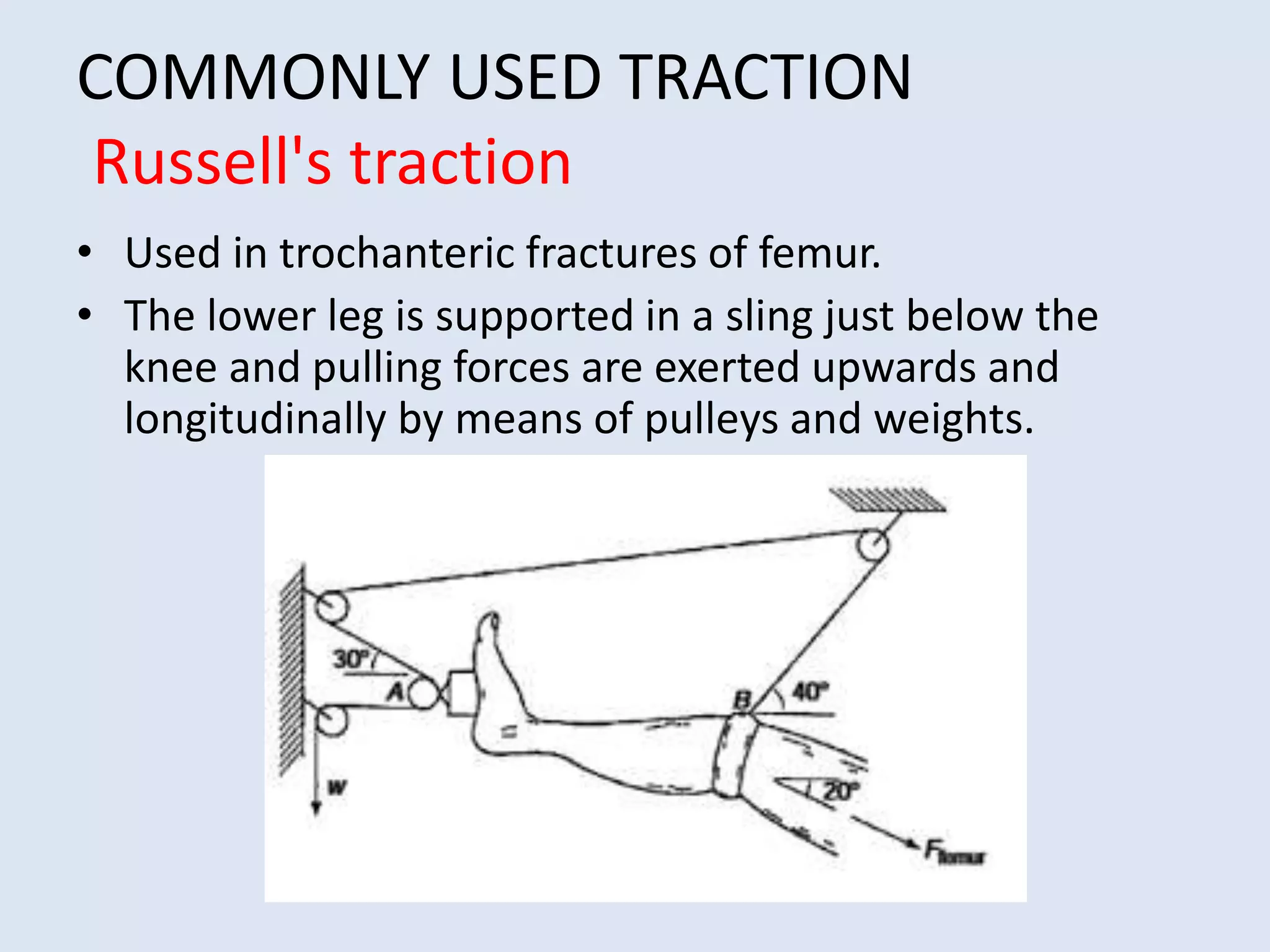 Immobilization used in Musculoskeletal injuries | PPTX