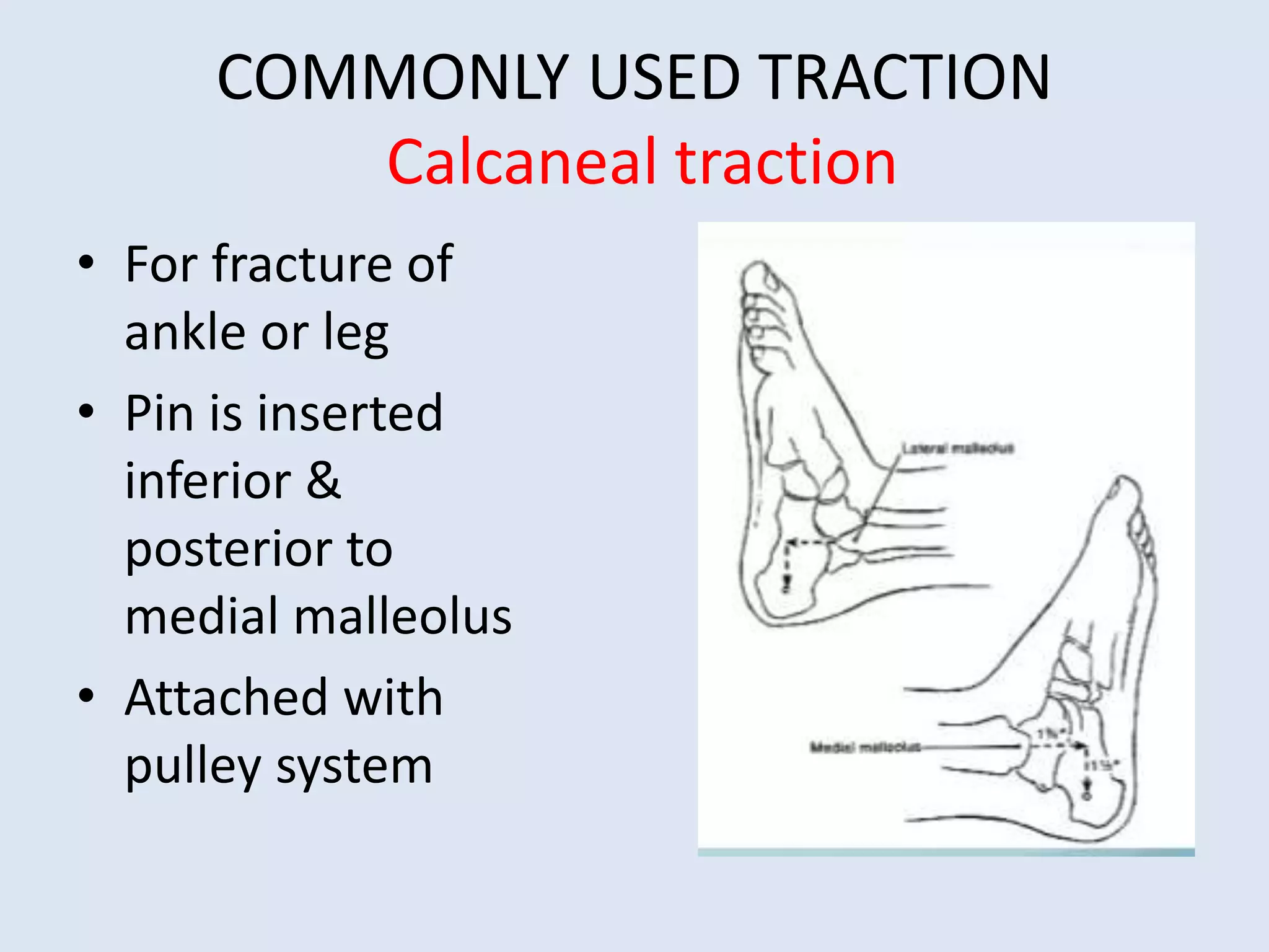 Immobilization used in Musculoskeletal injuries | PPTX