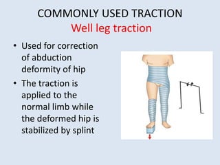 Immobilization used in Musculoskeletal injuries | PPTX