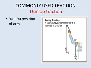 Immobilization used in Musculoskeletal injuries | PPTX