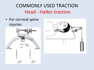 Immobilization used in Musculoskeletal injuries | PPTX