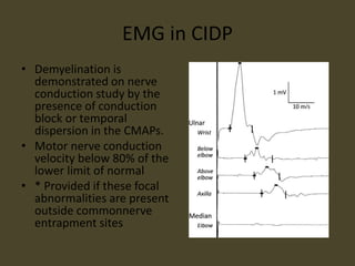 Immune mediated neuropathies | PPT