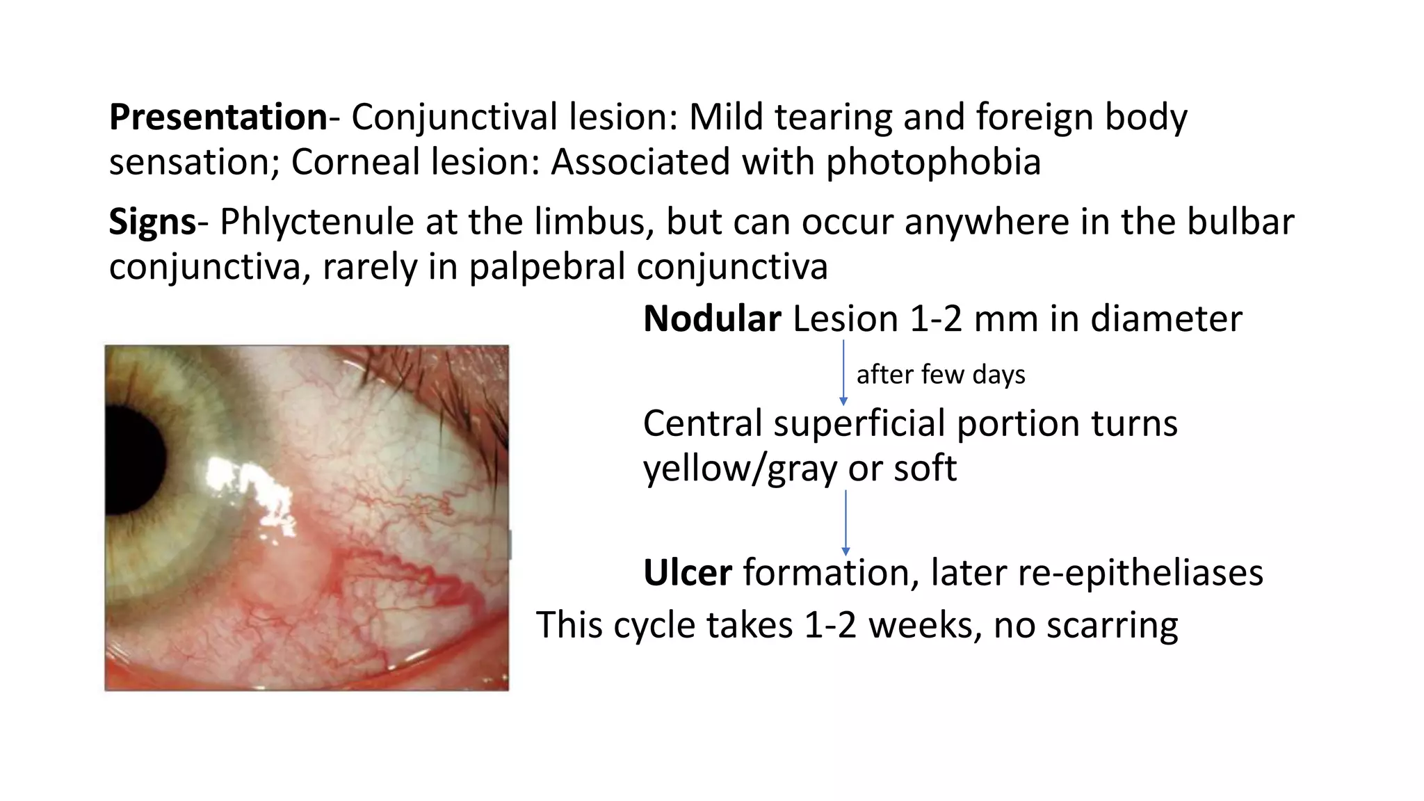 Immune disorders of the cornea | PPTX