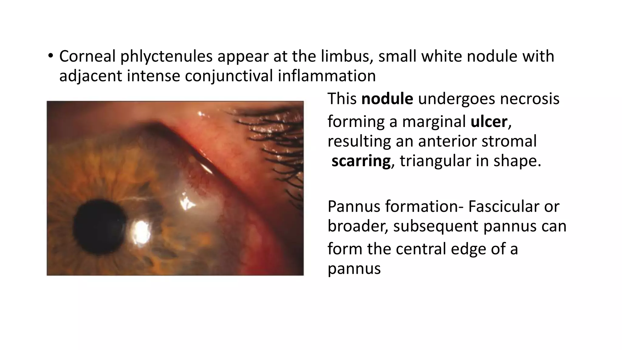 Immune disorders of the cornea | PPTX
