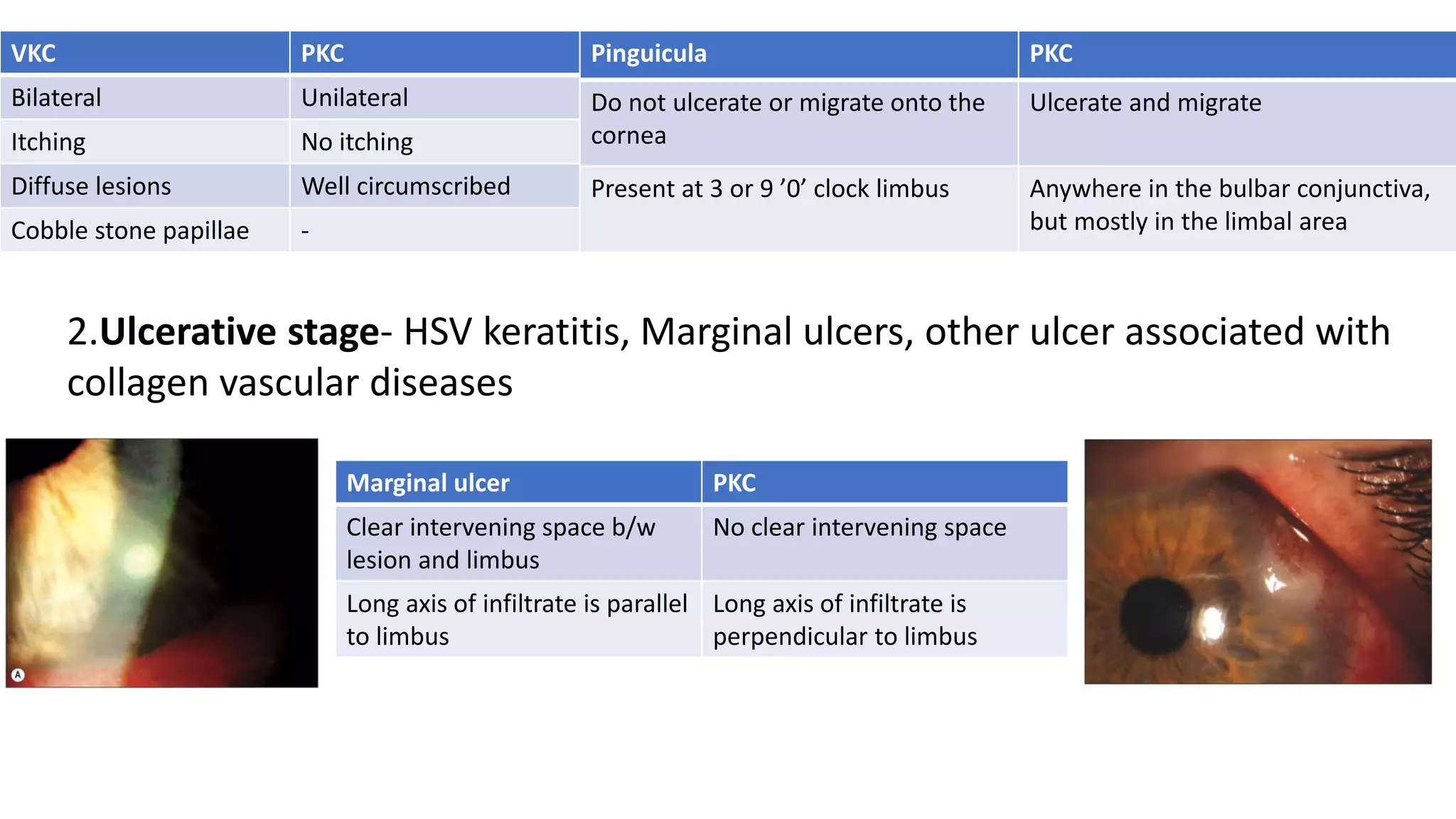 Immune disorders of the cornea | PPTX