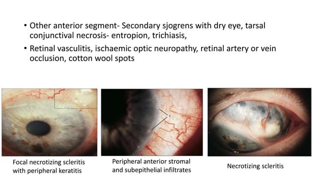 Immune disorders of the cornea | PPTX