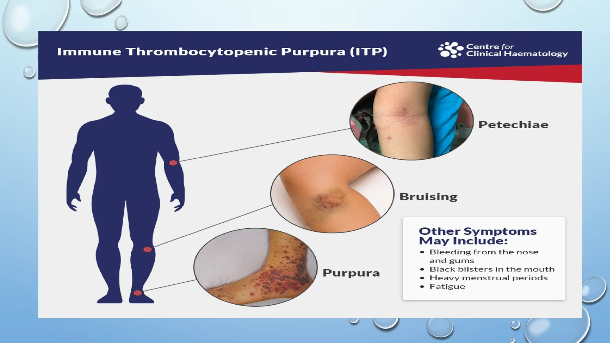 immune (idiopathic) thrombocytopenic purpura (.pptx