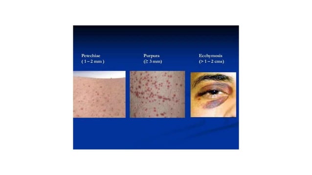 Immune Thrombocytopenic Purpura.pptx