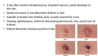 Immunization (pediatrics) | PPTX