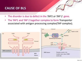Bare Lymphocyte Symdrome | PPTX