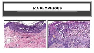 Immunofluorescence in dermatopathology | PPTX
