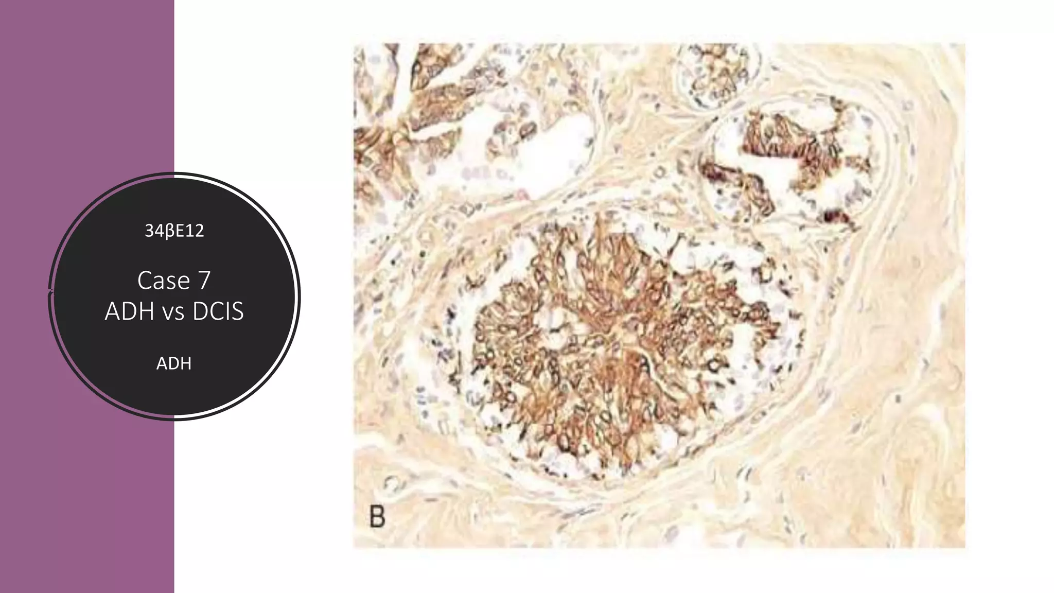 Immunohistochemistry in breast lesions | PPTX