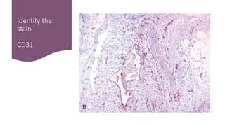 Immunohistochemistry in breast lesions | PPTX
