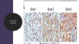 Immunohistochemistry in breast lesions | PPTX