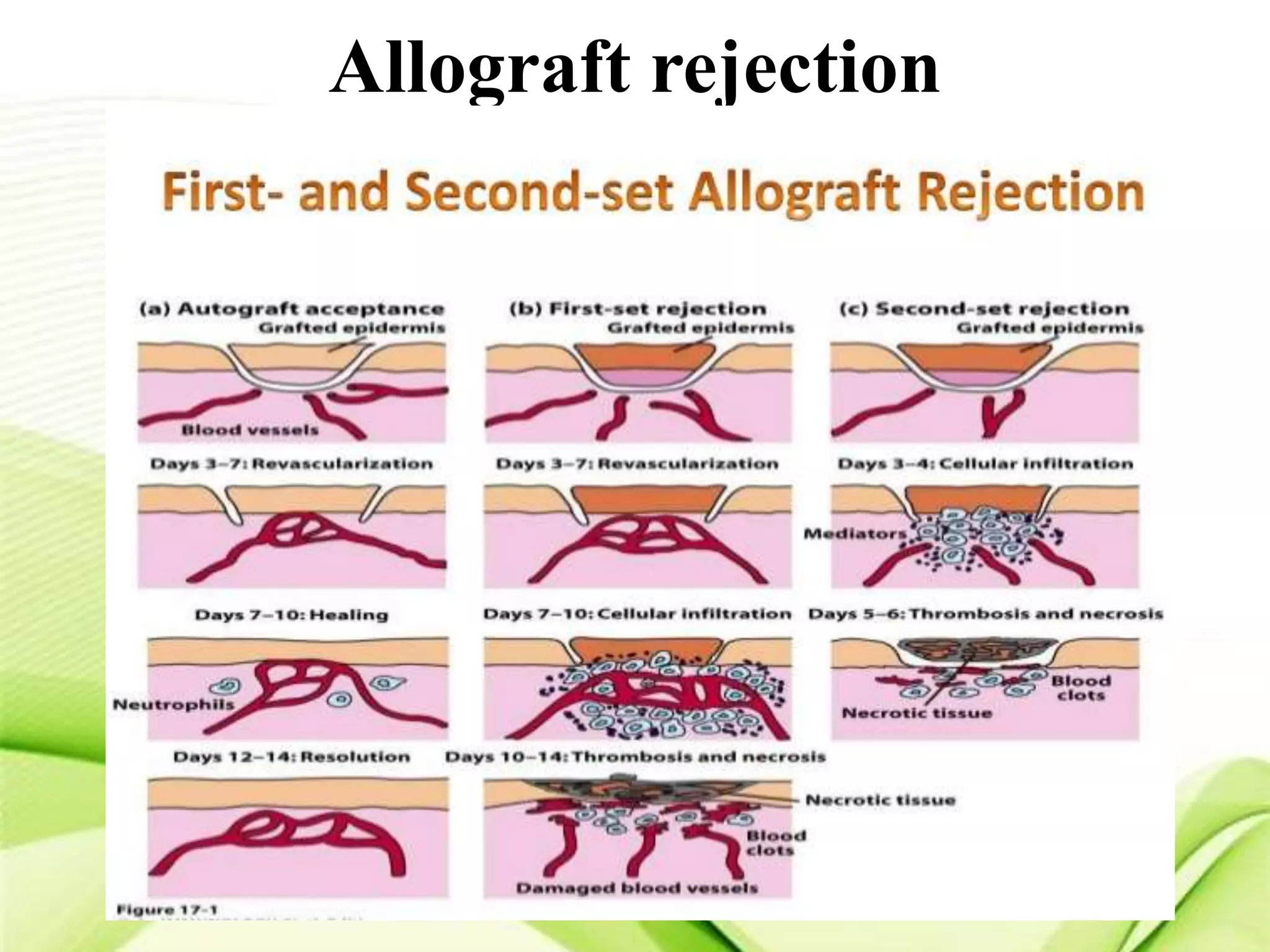 Immunological basis of graft rejection and mechanism of graft rejection ...