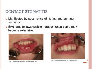Immunologic diseses of oral cavity | PPTX