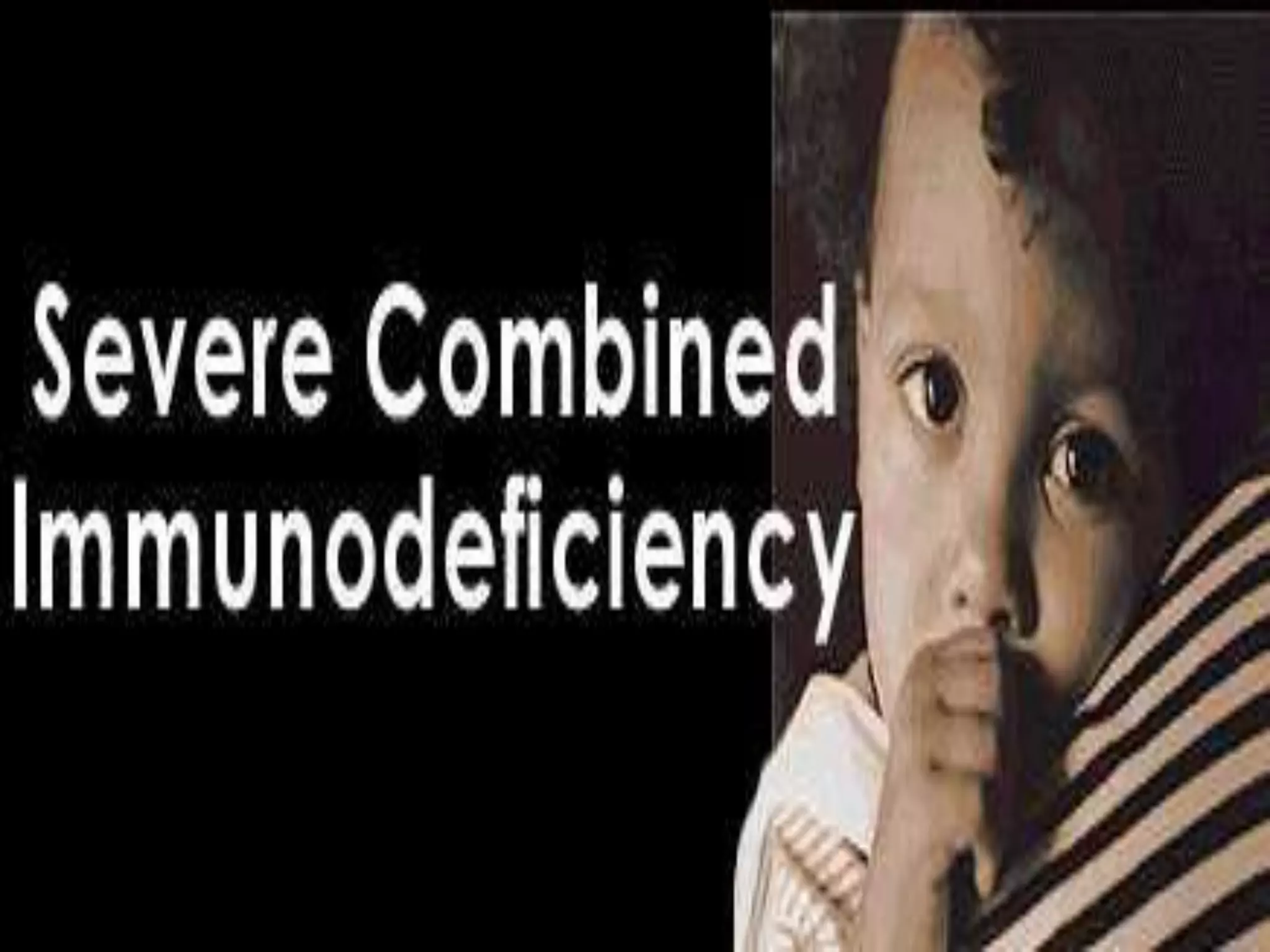 severe combined immunodeficiency | PPTX