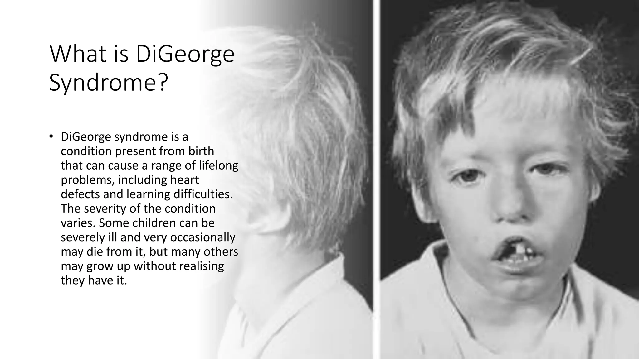 DiGeogressyndrome.pptx