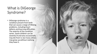 DiGeogressyndrome.pptx