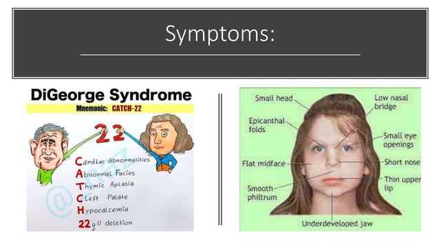 DiGeogressyndrome.pptx
