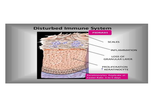 Immunopathology of psoriasis | PPTX | Skin and Dermatology | Diseases ...